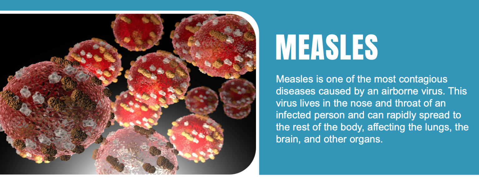 Measles cases reported in Los Angeles, Orange counties